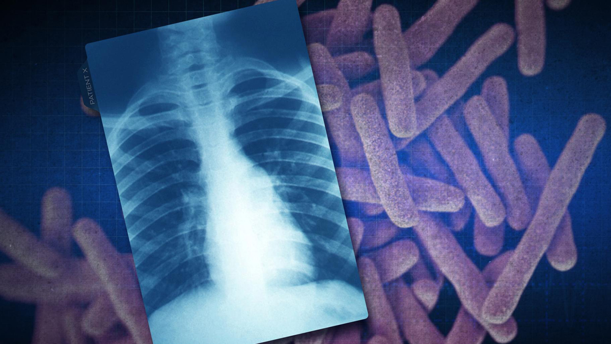 Tuberculosis: qué es y cómo te puede afectar – Telemundo Puerto Rico