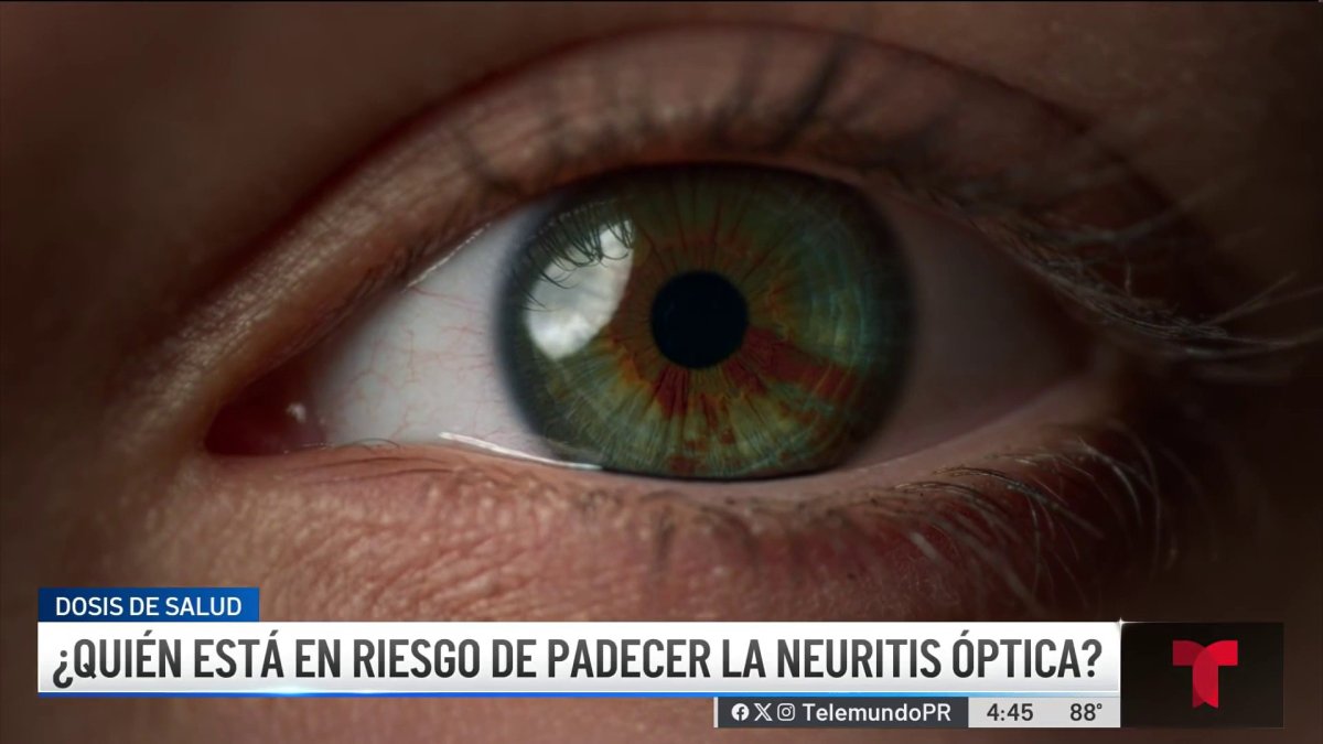Neuritis óptica: qué es y cuáles son los síntomas – Telemundo Puerto Rico
